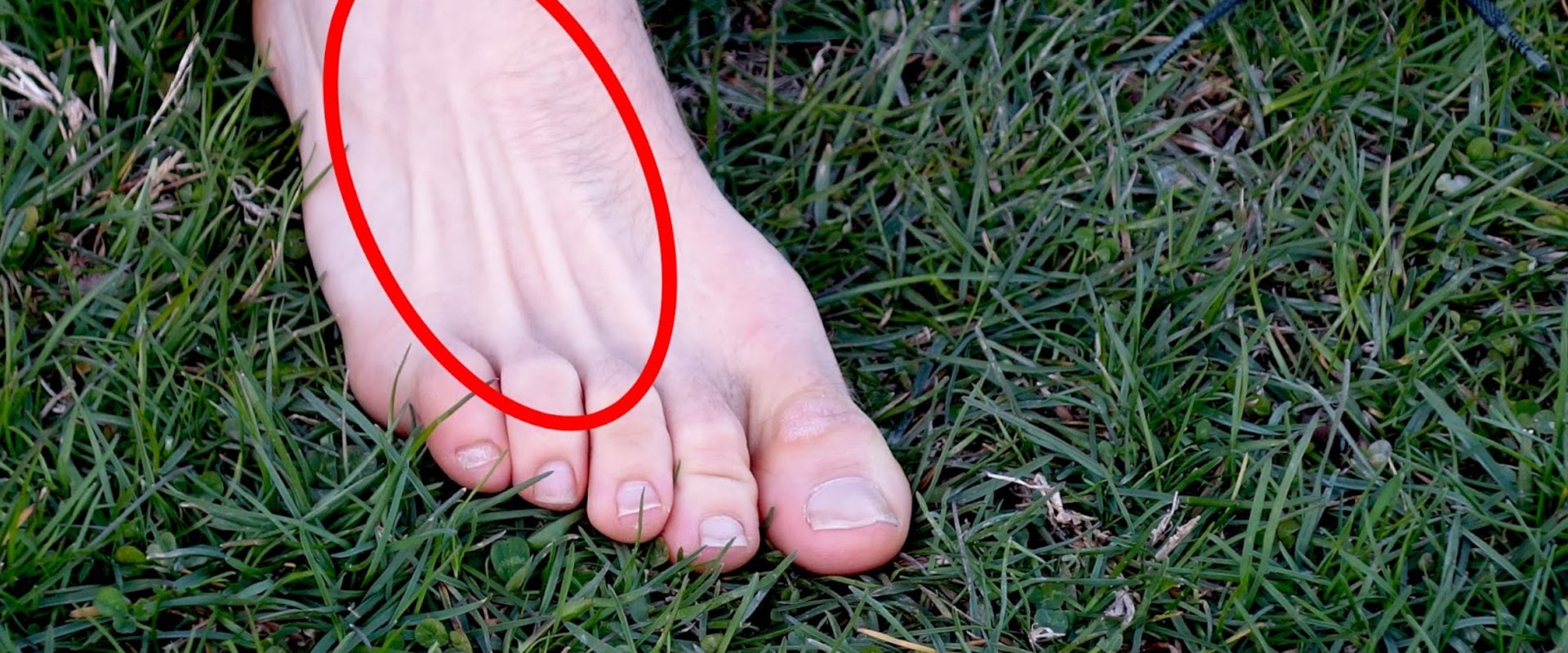 Expert Tips for Differentiating Between Tendonitis and Stress Fractures ...